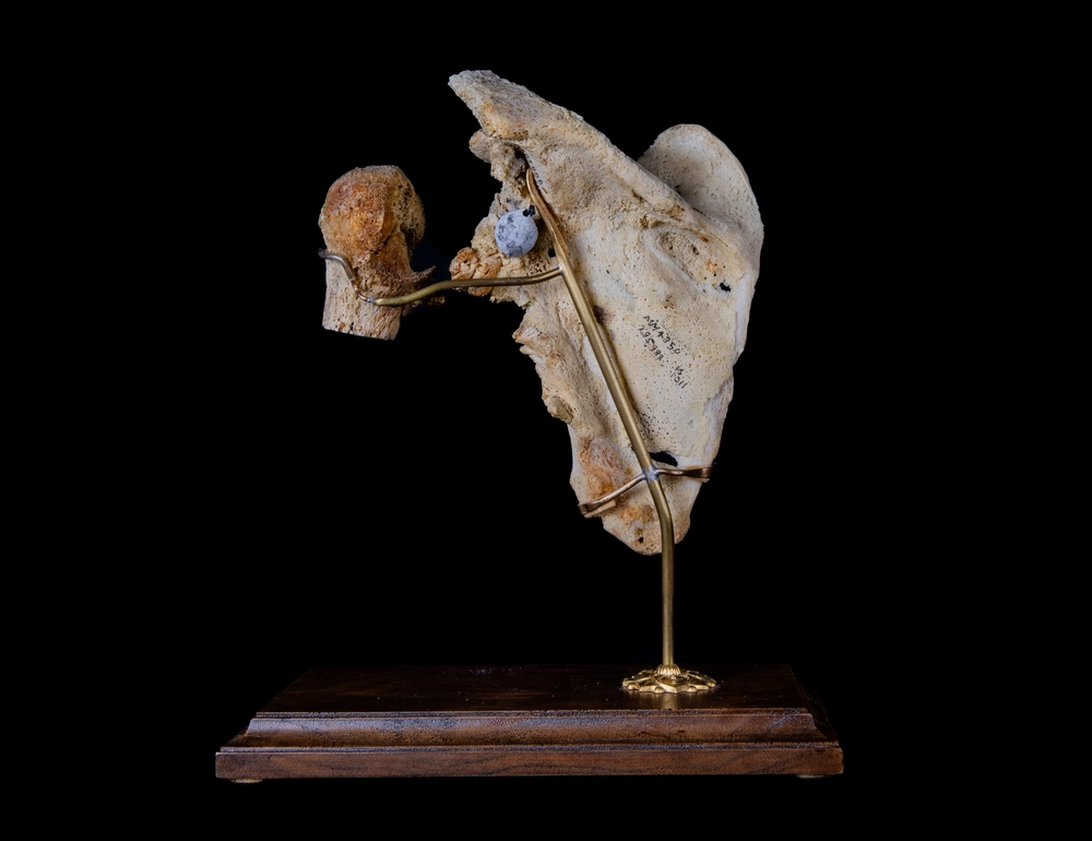 DVIDS - Images - Scapula and Humerus, Osteomyelitis [Image 4 of 11]